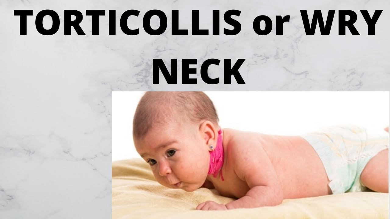 TORTICOLLIS-WRY NECK IN ORTHOPAEDICS - YouTube