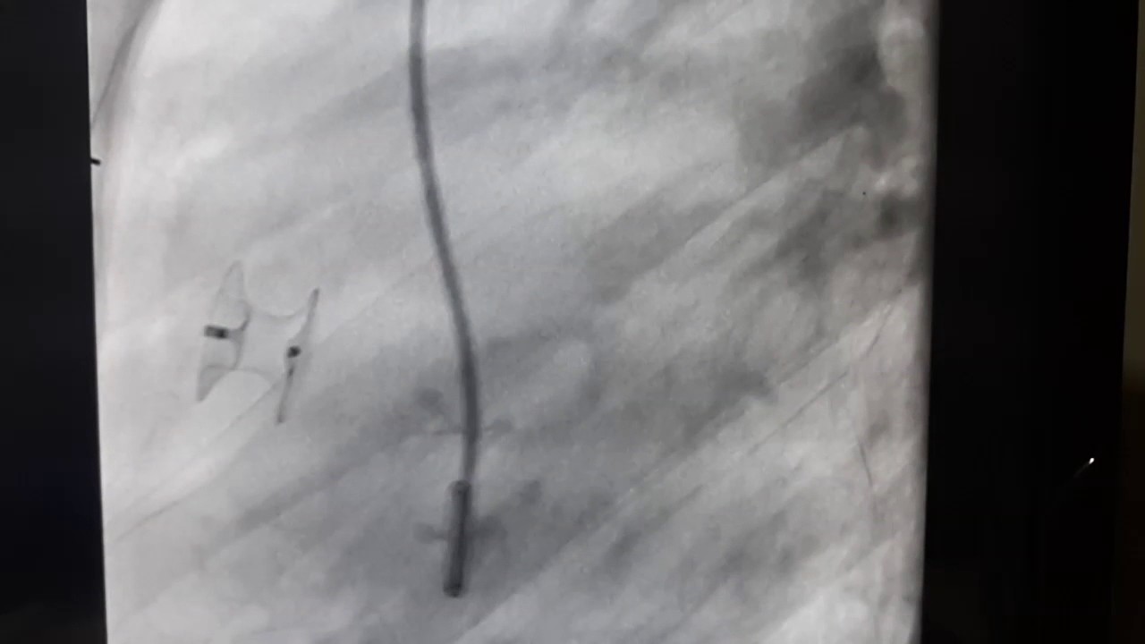 Multiple VSD device closure in post TOF repair child - YouTube
