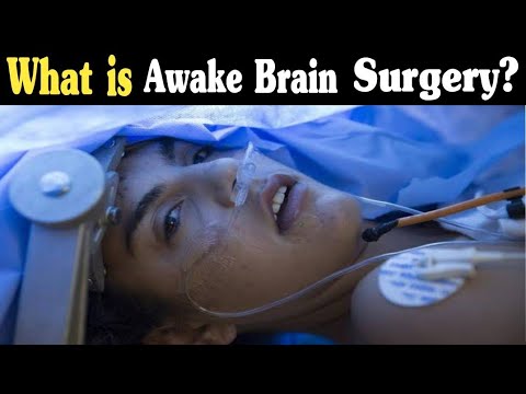 How Awake Brain Surgery is performed? | Awake Craniotomy (3D Animation ...
