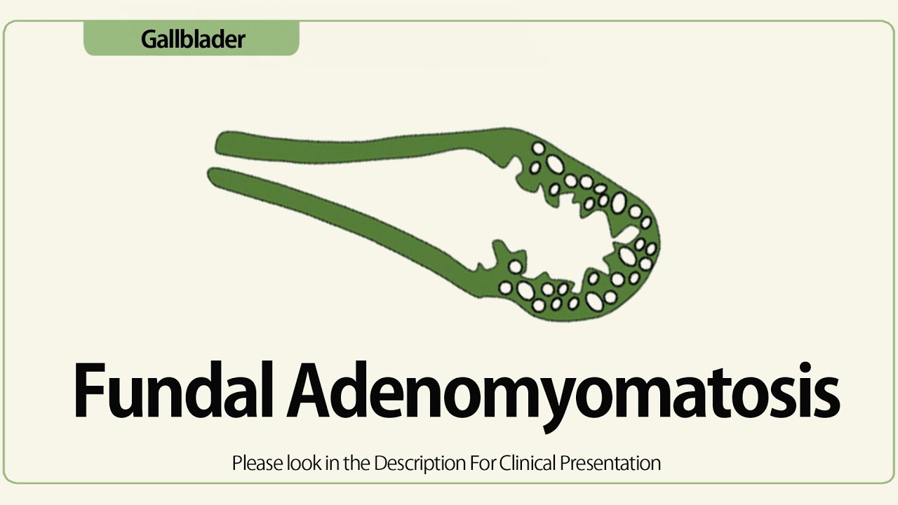 Linear EUS: Gallbladder Fundal Adenomyomatosis - YouTube