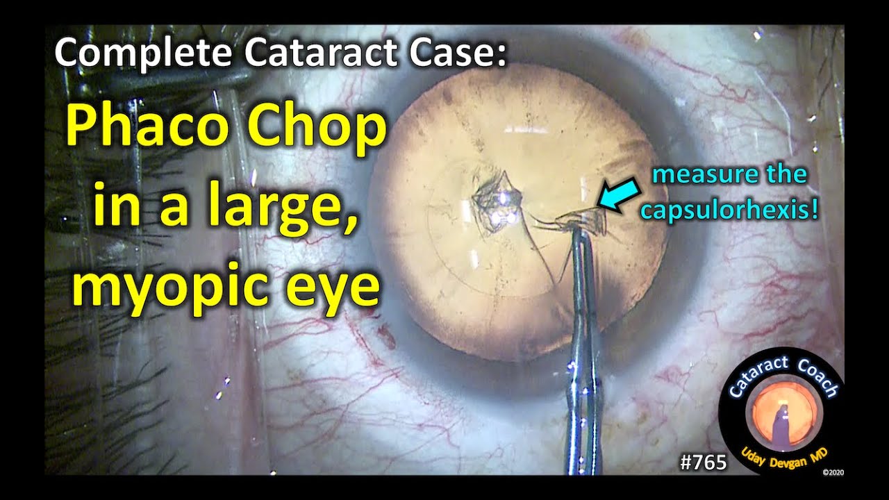 complete cataract case: phaco chop surgery in a myopic eye - YouTube