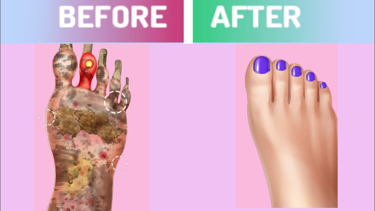 ASMR Doctor world best Foot surgery - YouTube