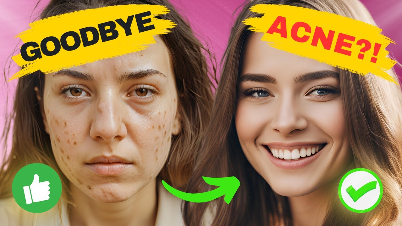Secrets to Clear Skin Without Spending a Dime - No More Acne - YouTube