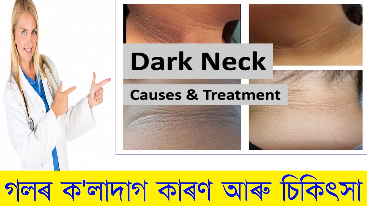Dark Neck Causes Treatment and Home Remedies | How to get rid of dark ...