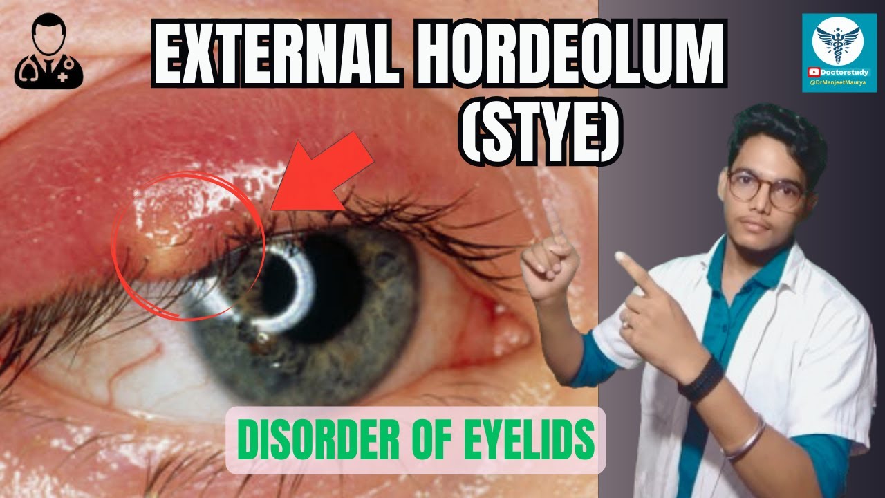 External Hordeolum (Stye) | Etiology, Stages & Management | eyelid ...