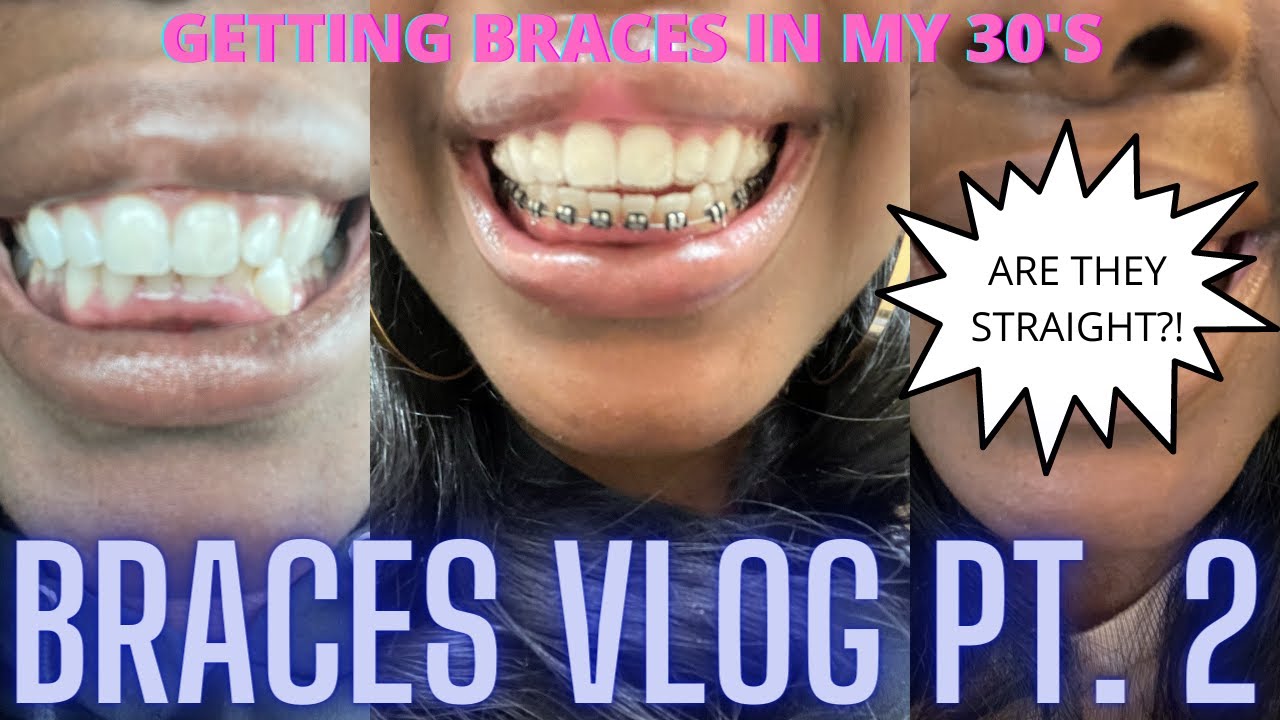 COME WITH ME TO GET MY BRACES OFF‼️| VLOG| 2022| PRETTY NICI - YouTube