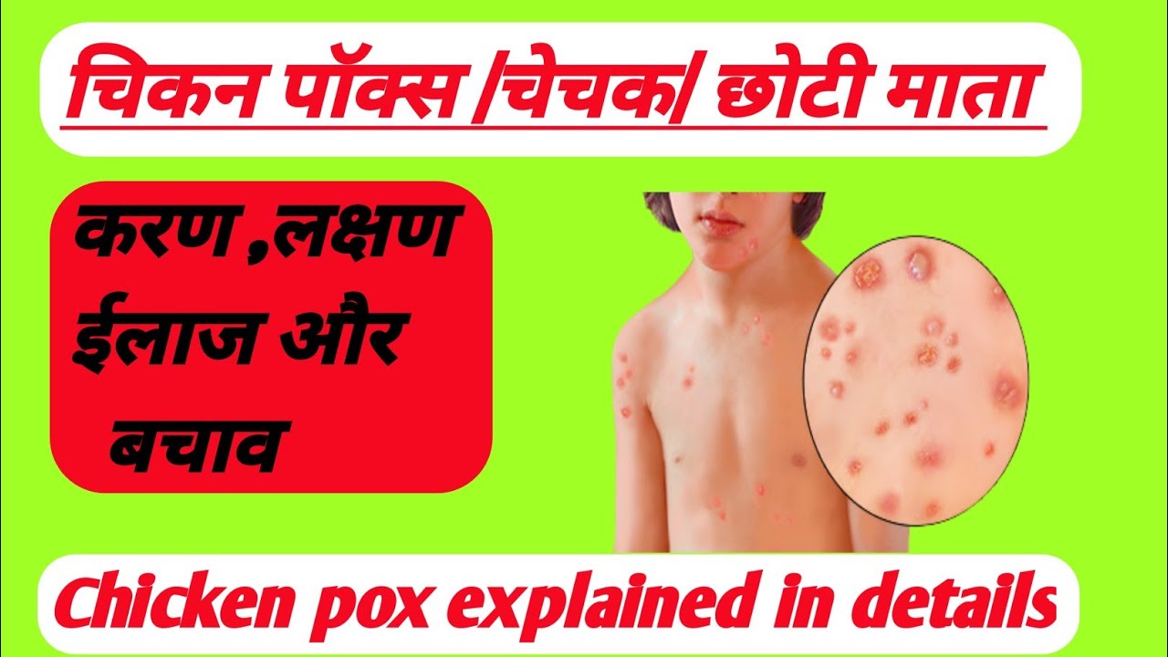Chicken pox ! small pox treatment ! Antiviral medicine चेचक! छोटी माता ...