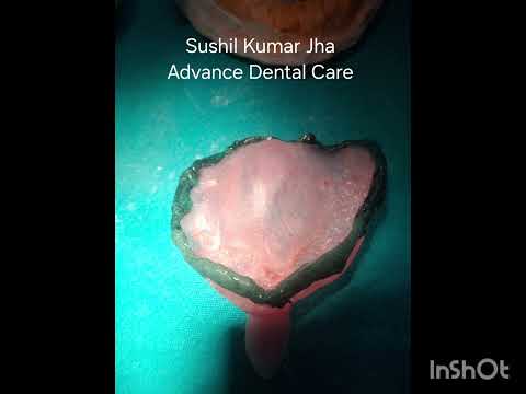 Final impression for complete denture after border moulding . ZnoE paste used for the impression. 😊🙏