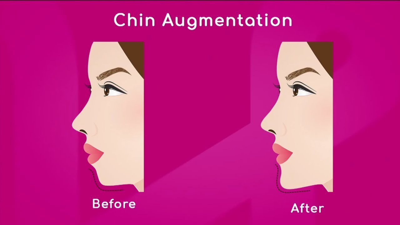 Chin Augmentation - YouTube