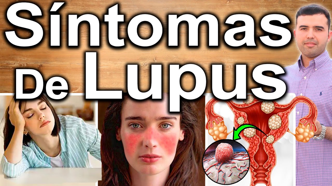TIENES LUPUS Y NO LO SABES - Sintomas De Lupus Autoinmune Antes Que Sea ...