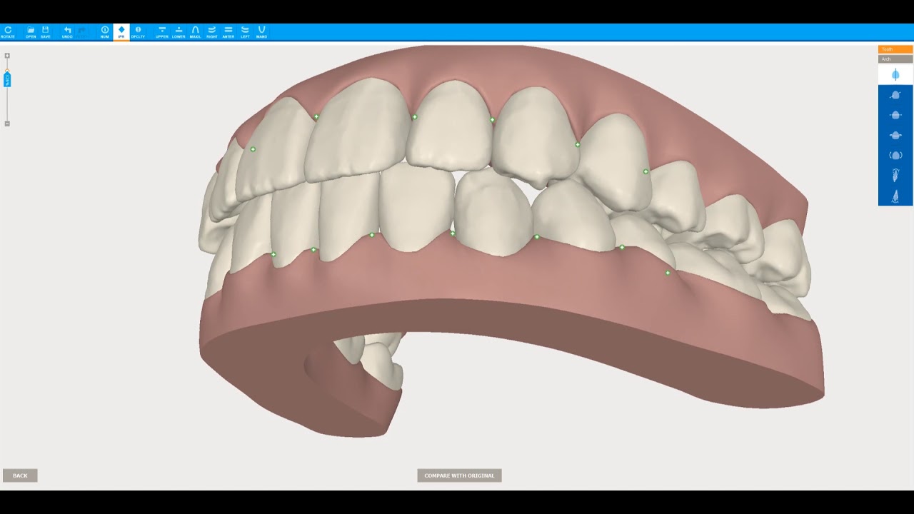 invisalign outcome simulator - YouTube