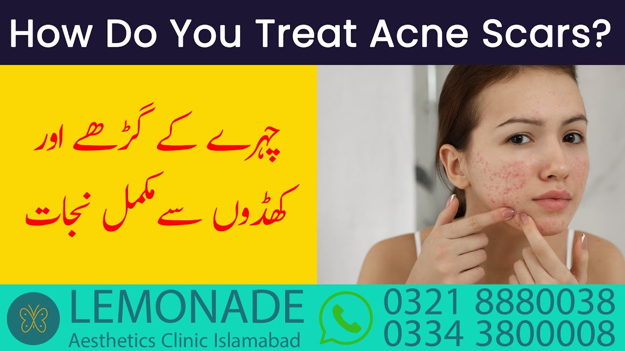 Acne Types, Causes, Treatment & Prevention Islamabad Lahore Karachi ...