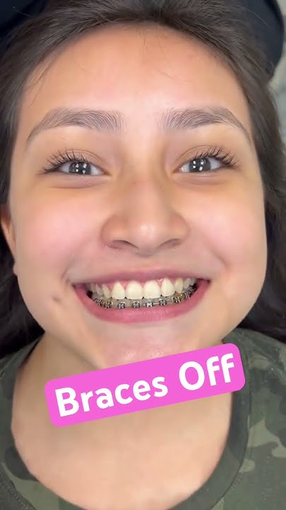 Braces Off in 5 seconds!!! 🦷 #bracesoff #braces #orthodontist - YouTube