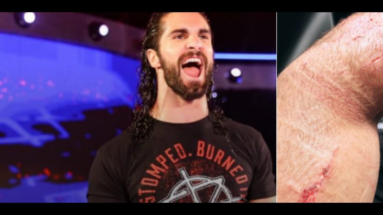 SETH ROLLINS SHOWS OFF NASTY INJURY FOLLOWING RAW! Seth Rollins Busted ...