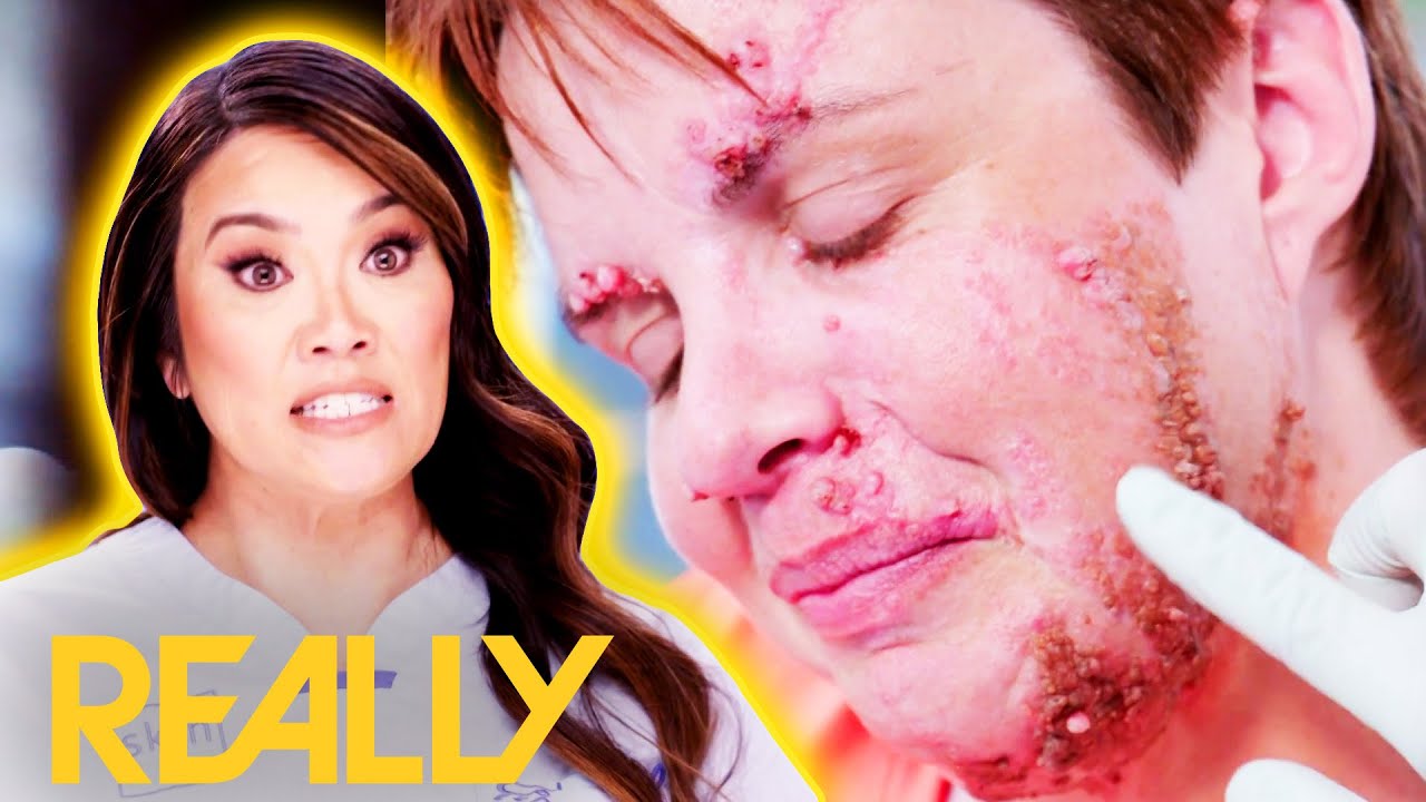 Dr. Lee Assists A Woman With Painful Bumps On Her Face | Dr. Pimple ...