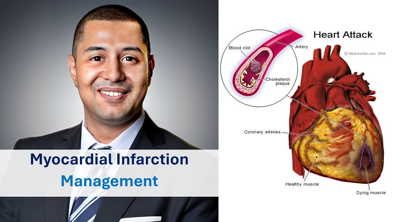 Acute Myocardial Infarction Management - YouTube