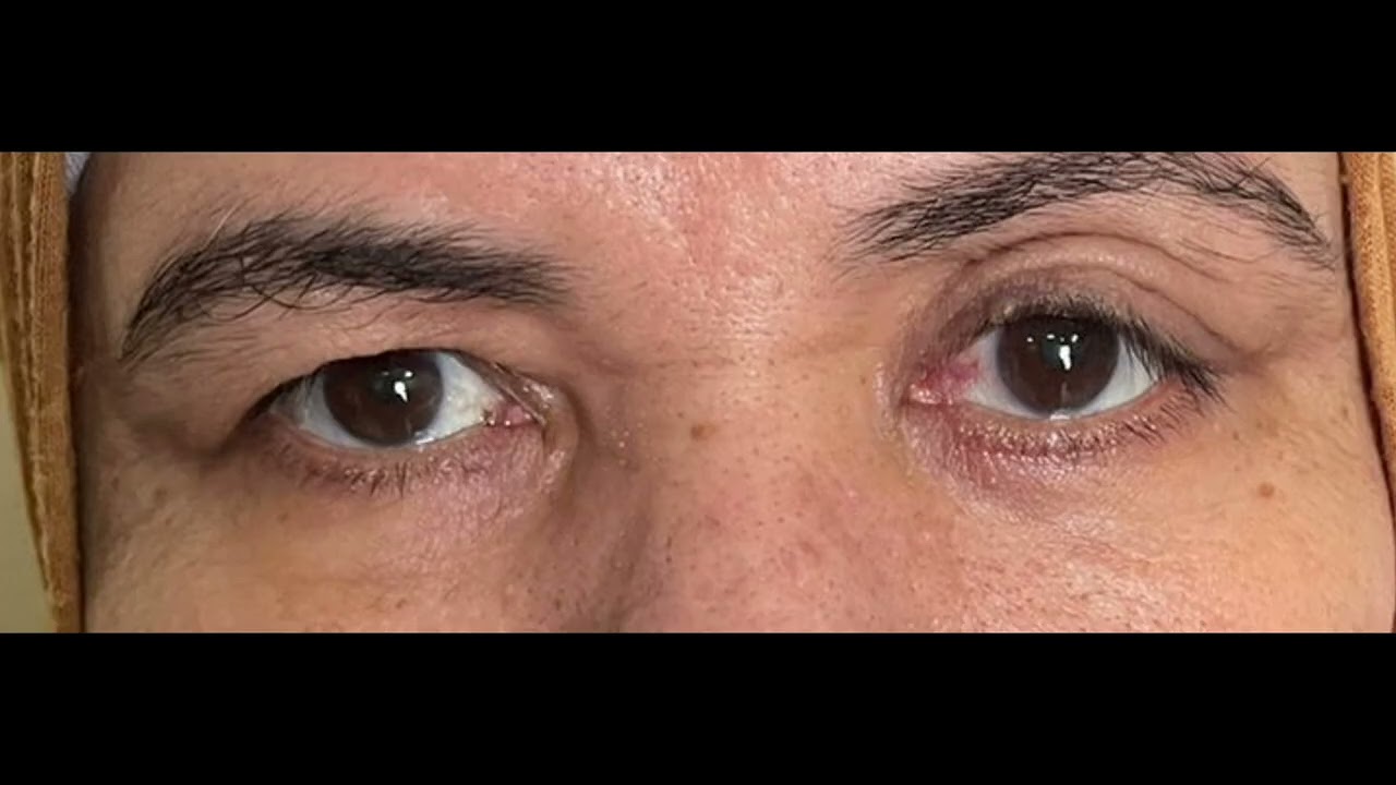 Excision of an extraconal superior orbital mass through anterior ...