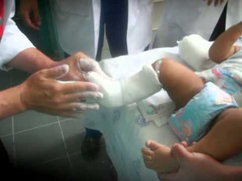 PEVC PONSETI 2DO YESO.CQUIROGA - YouTube