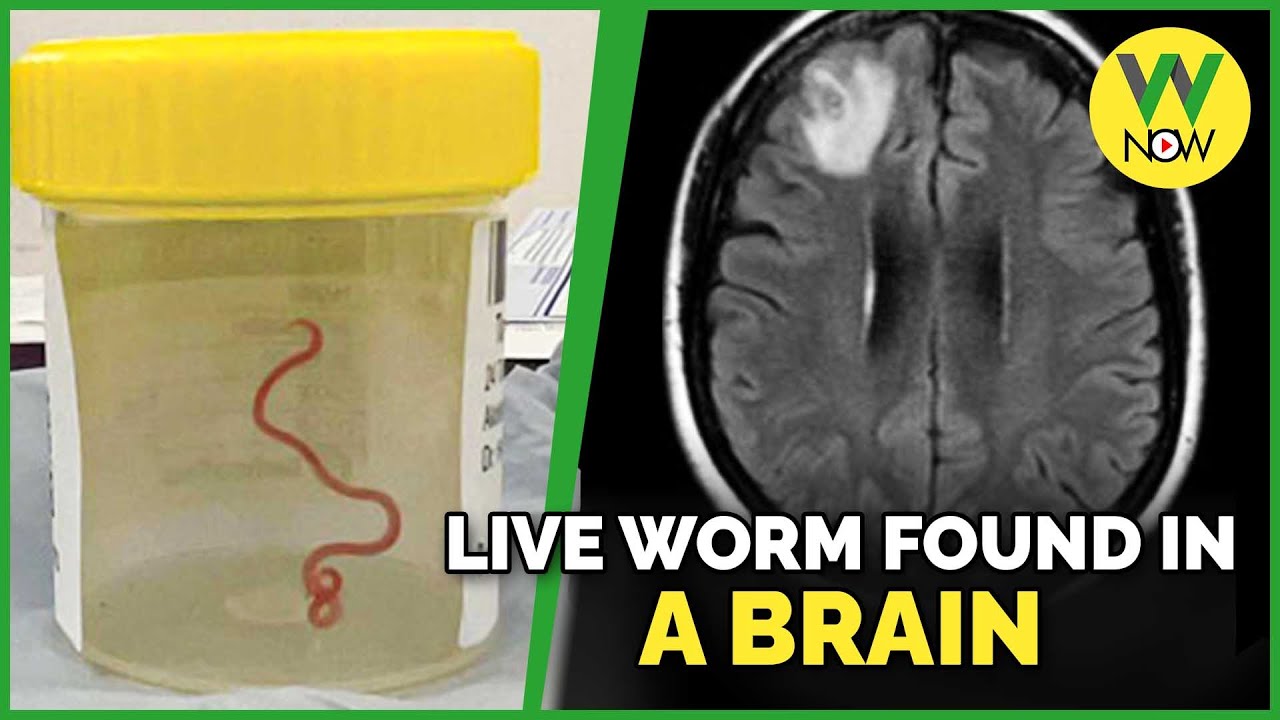 Live worm found in a brain - YouTube