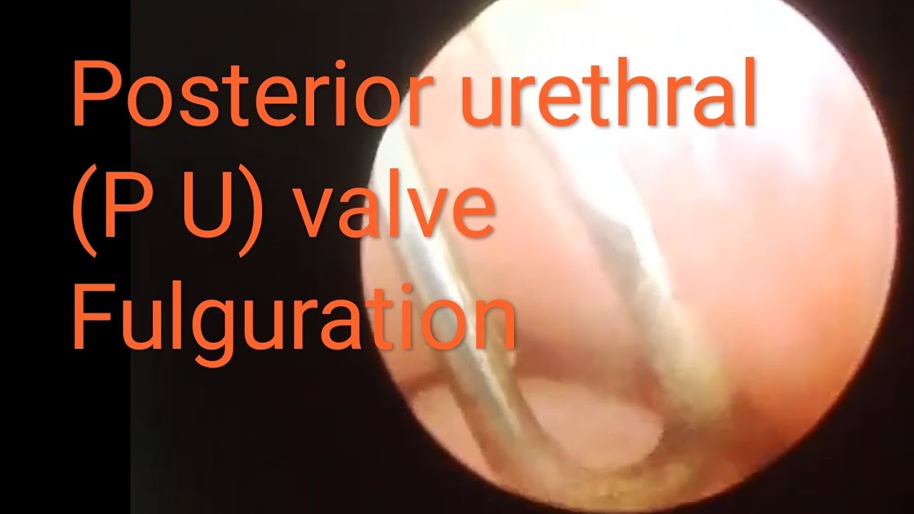 Posterior urethral valve fulguration [PU VALVES] - YouTube