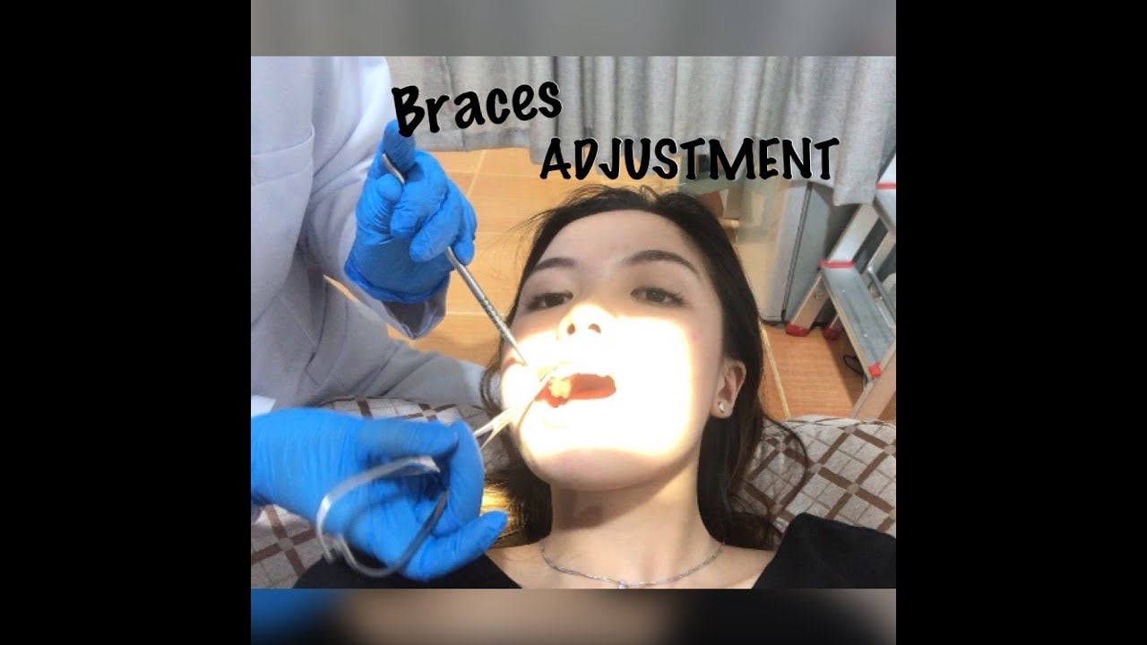 Braces Adjustment Kash Sangalang Youtube
