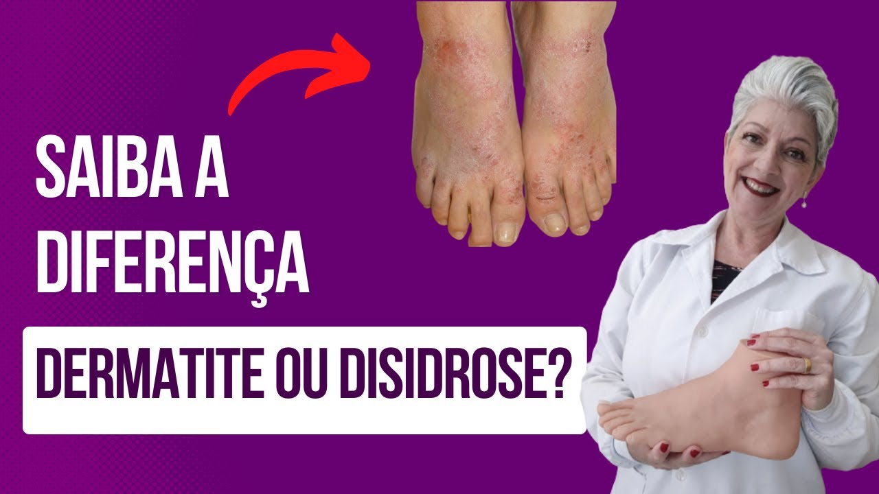 DERMATITE ou DISIDROSE Saiba a Diferença - YouTube