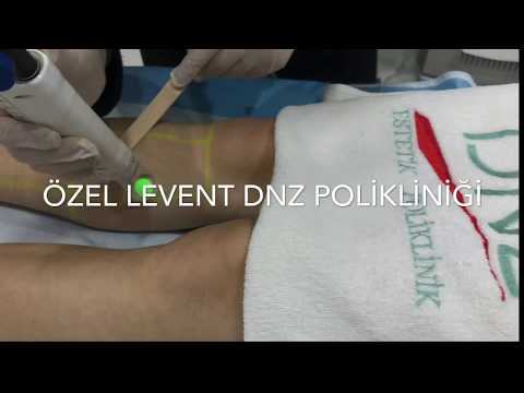 Dnz Polikliniği | Bacak Lazer Epilasyon