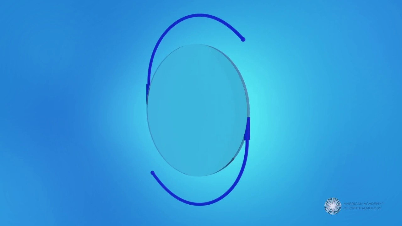 What is a monofocal intraocular lens (IOL)? - YouTube