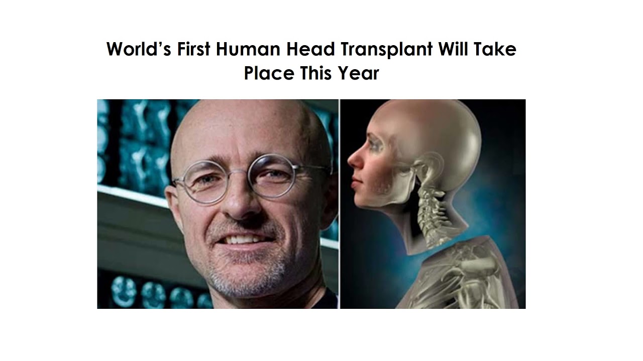 World’s First Human Head Transplant - YouTube