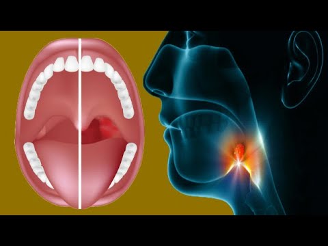Tonsil Cyst: Is It Serious? - YouTube