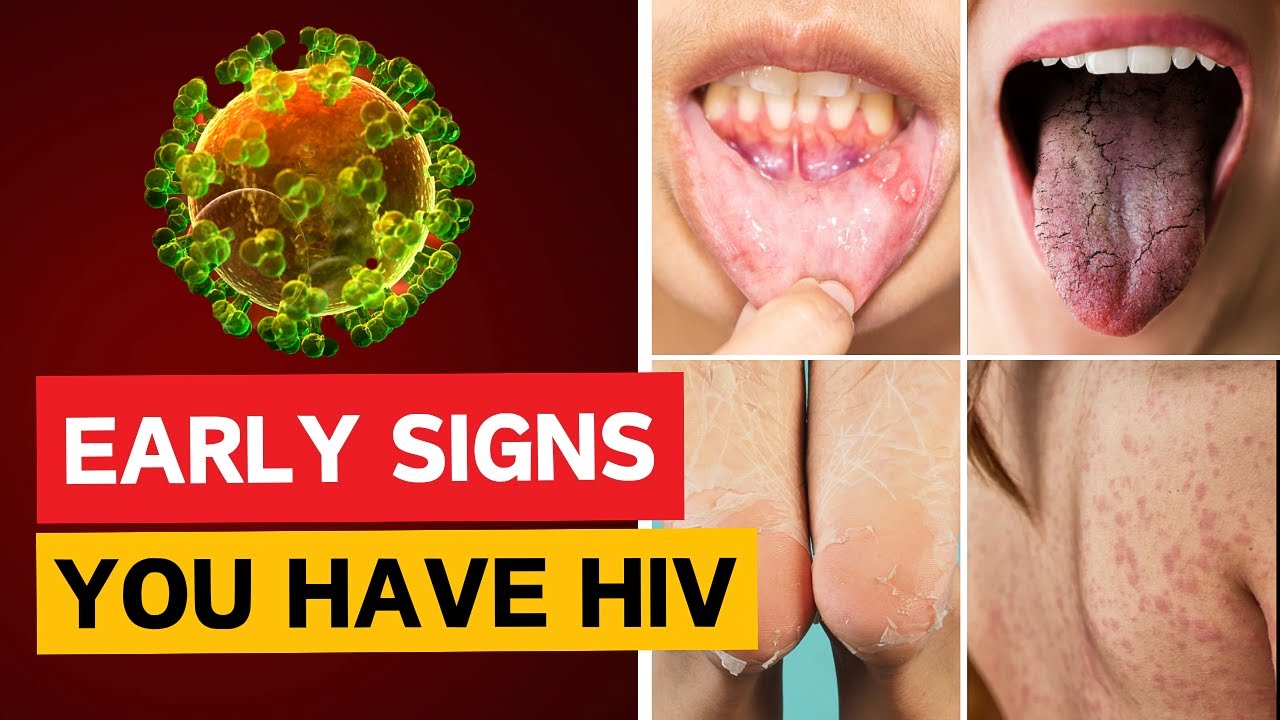 10 Early Signs and Symptoms of: HIV in Men You Need to Know - YouTube