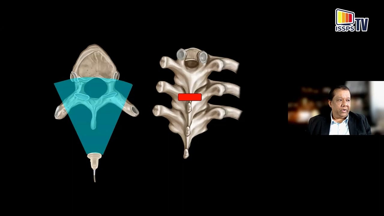 Ultrasound Imaging of the Thoracic Spine & Epidural Injection Technique ...