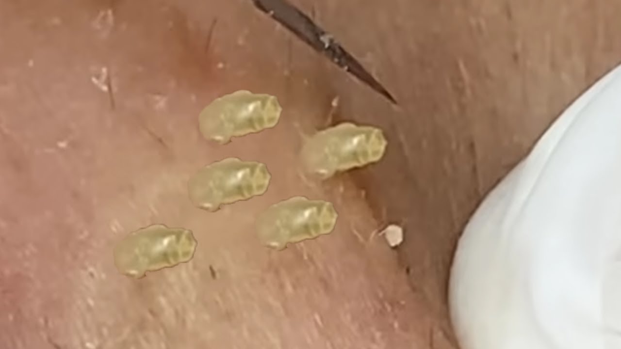 Super blackhead extraction new this week,zits blackheads pimples,acne ...