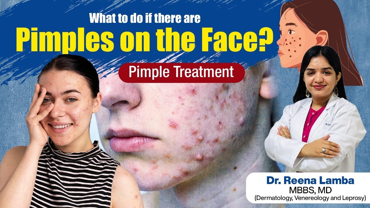 What to do if there are Pimples on the Face? Pimple Treatment | Acne ...
