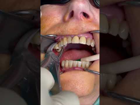 Can A Dentist Remove Multiple Teeth At Once
