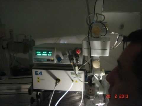Endolaser treatment for Glaumoma - YouTube