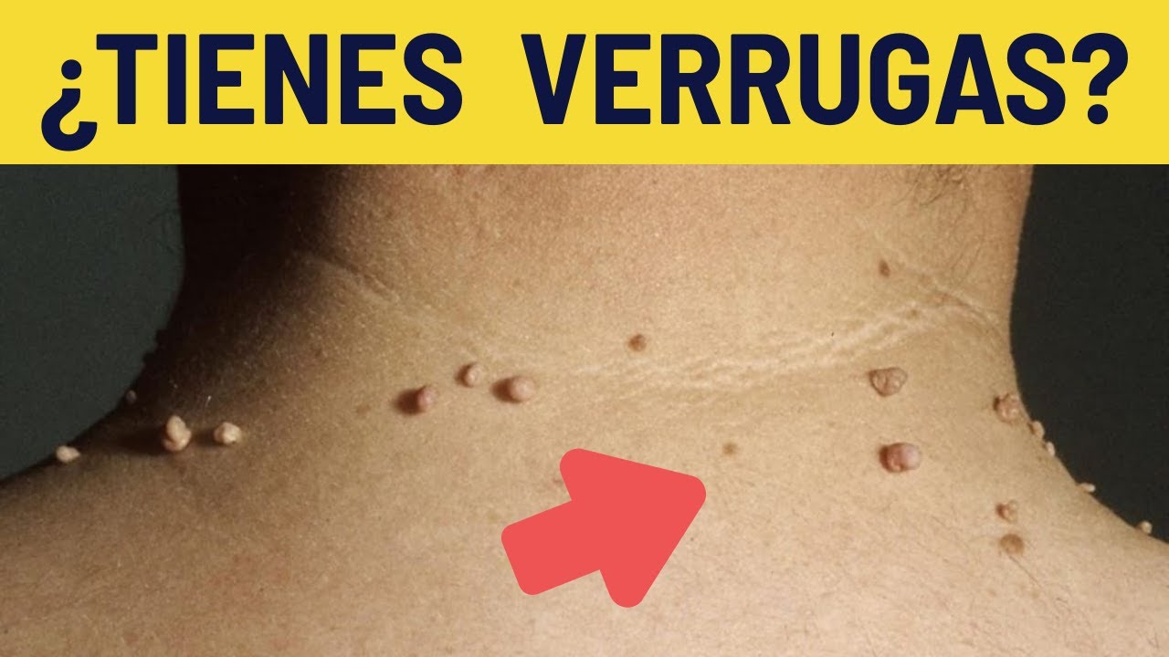 ¿VERRUGAS EN EL CUELLO? - fibromas blandos, acrocordones y resistencia ...