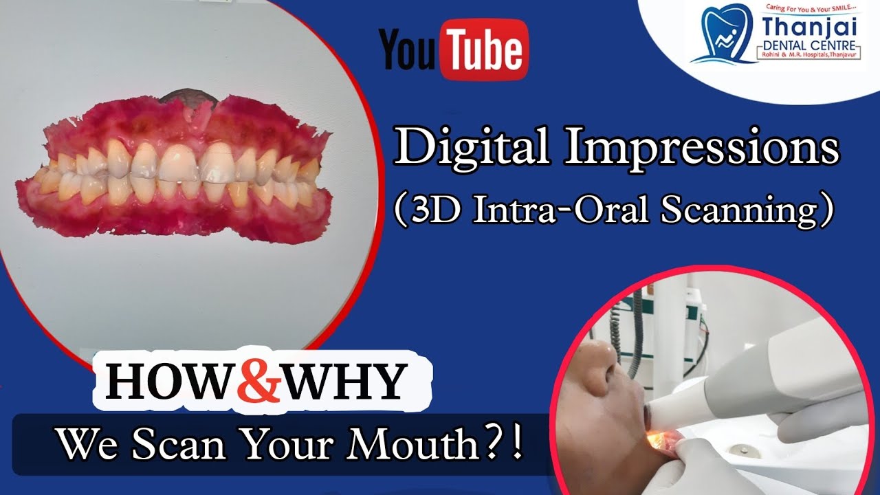 Intraoral Scanning Video | Digital Impressions | Digital Dental clinic ...