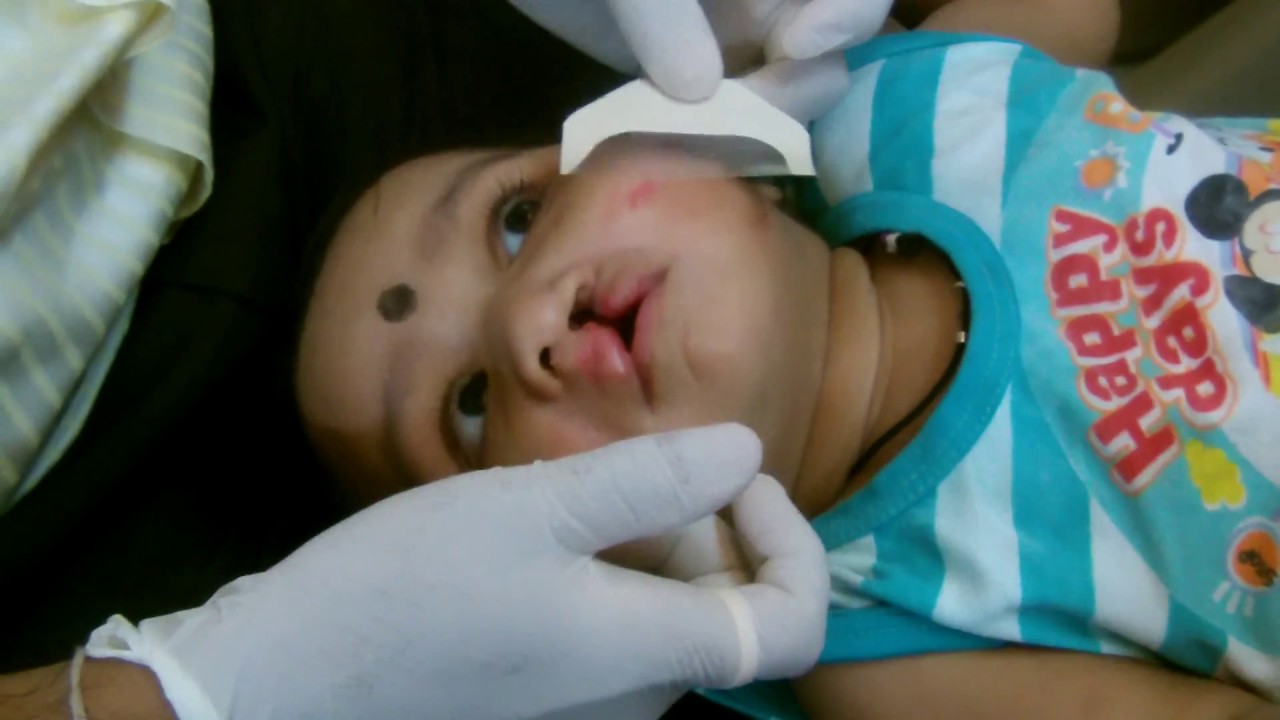 Nasoalveolar moulding taping method baby with cleft - Best cleft ...