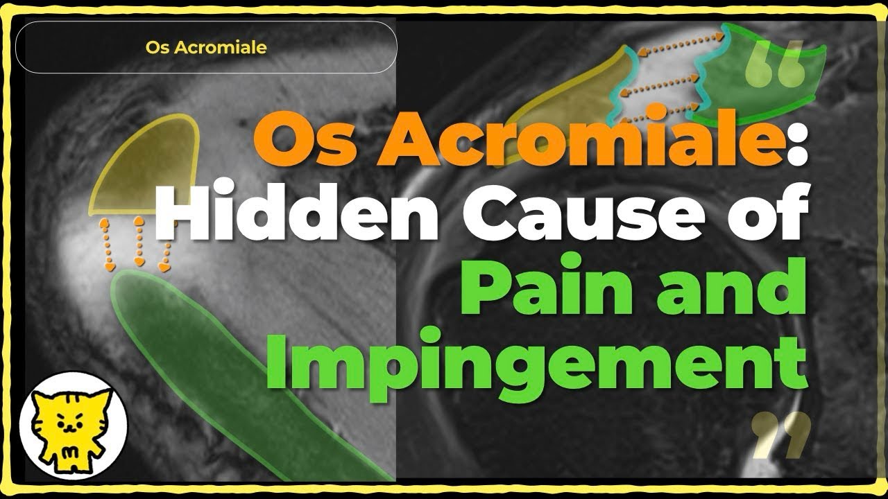 Os Acromiale: Hidden Cause of Shoulder Pain and Impingement - YouTube