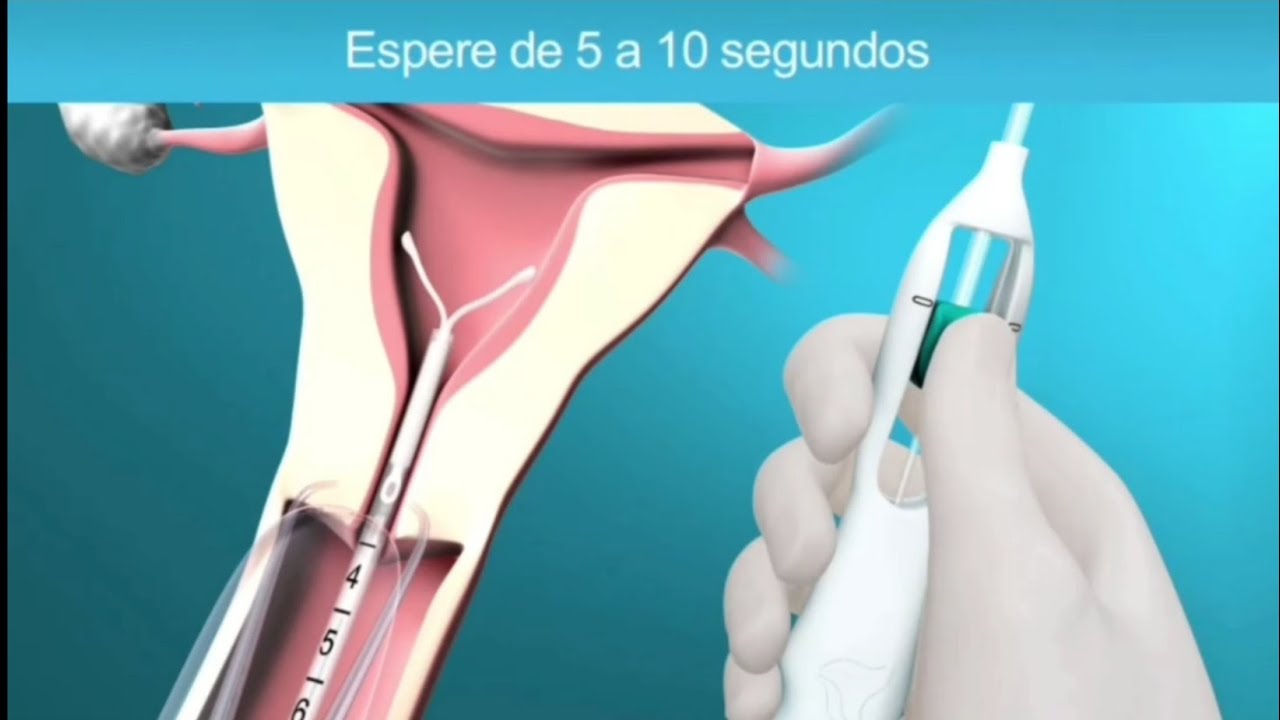 Inserção Mirena e Kyleena - Passo a passo - YouTube