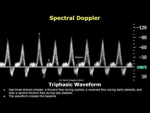 Monophasic, Biphasic & Triphasic Spectral Doppler Waveforms | Vascular Ultrasound Analysis (USG ...