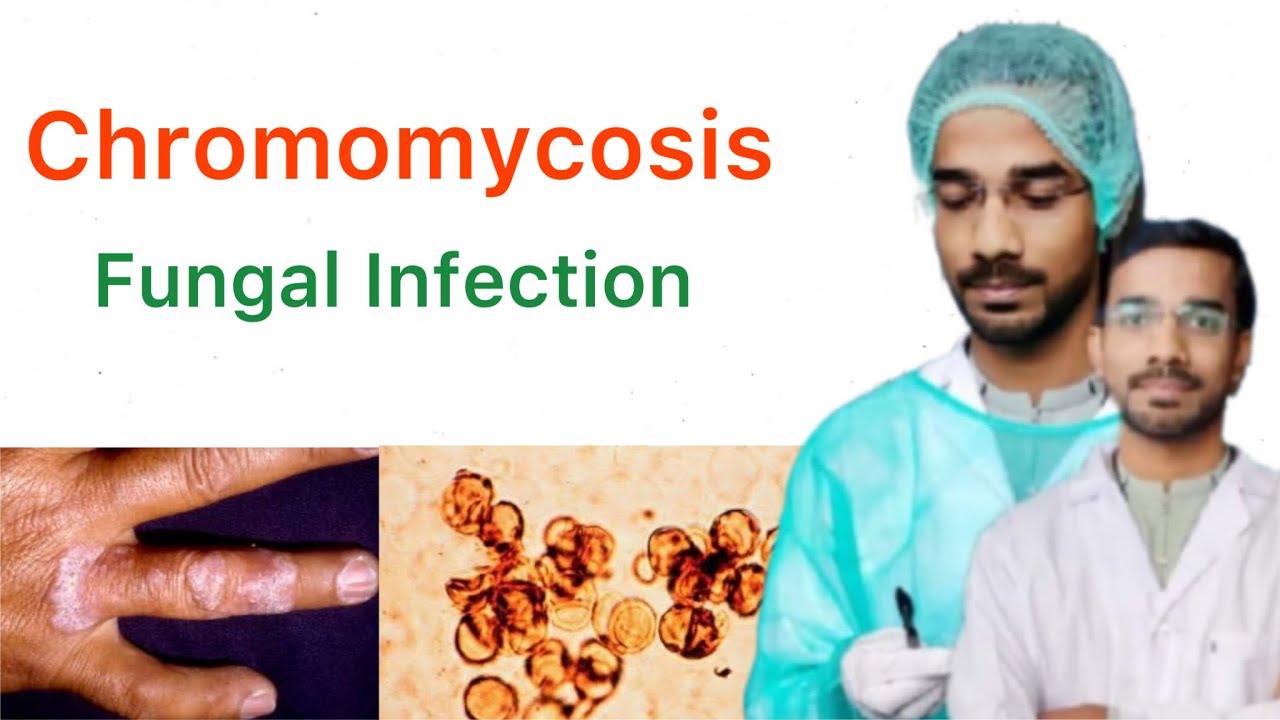 Chromomycosis | Sub-Cutaneous Mycosis - YouTube