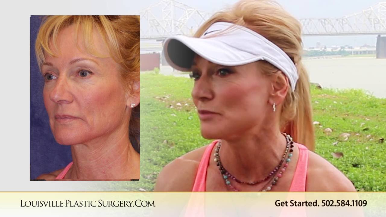Mini Facelift Tawnia Recovery Timeline - YouTube