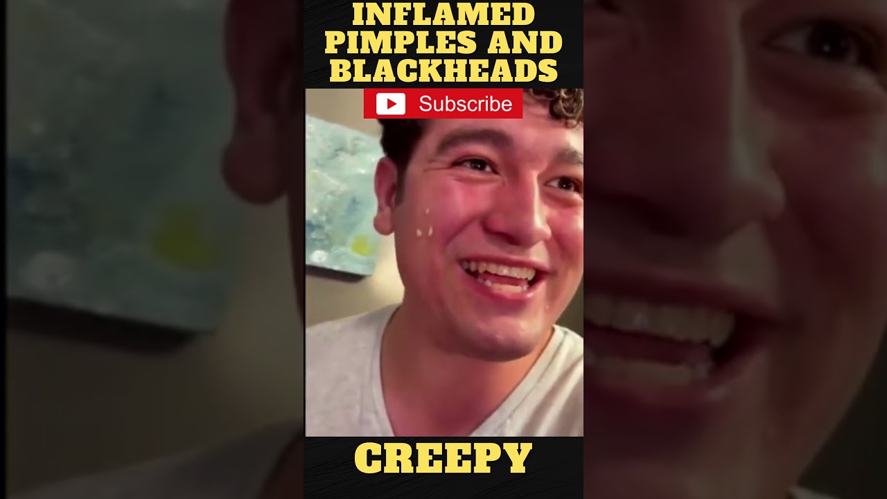 Giant Pimple Explosion Cyst Popping | Acne Pus Blackheads Bursting ...