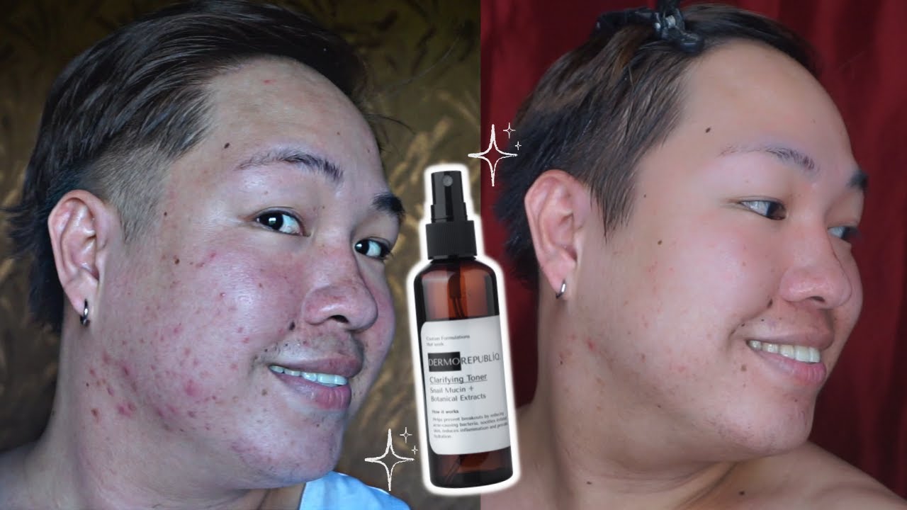 DERMOREPUBLIQ CLARIFYING TONER - HONEST REVIEW / TONER FOR BREAKOUTS ...