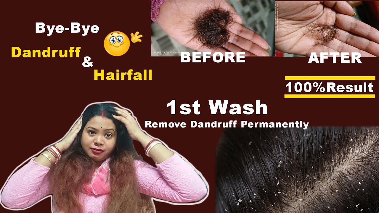 I Tried 5 Home Treatments for Dandruff and Got SHOCKING Results! - YouTube