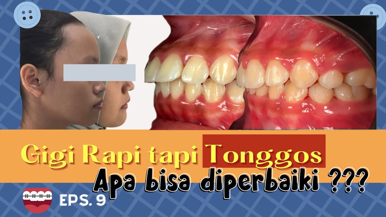 Gigi Rapi Tapi Tonggos Apa Bisa Diperbaiki Eps 9 Youtube