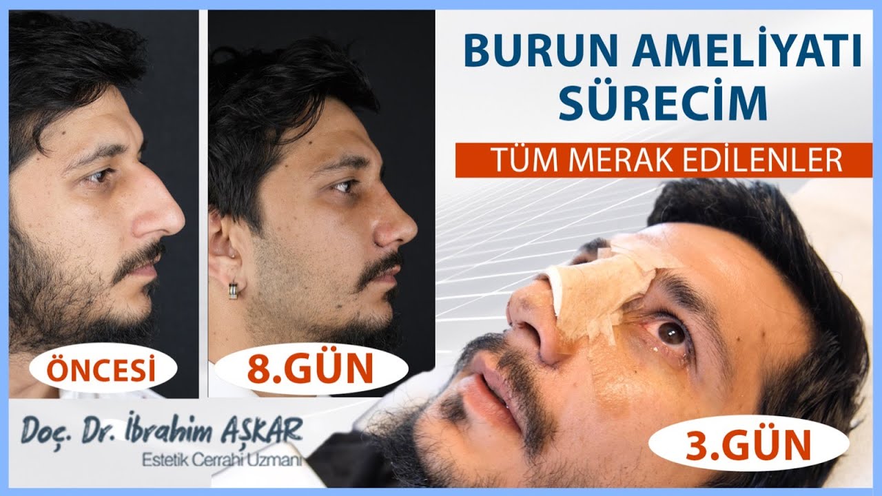 BURUN AMELİYATI SÜRECİM / TÜM MERAK EDİLENLER!! (Kapalı Burun Estetiği ...