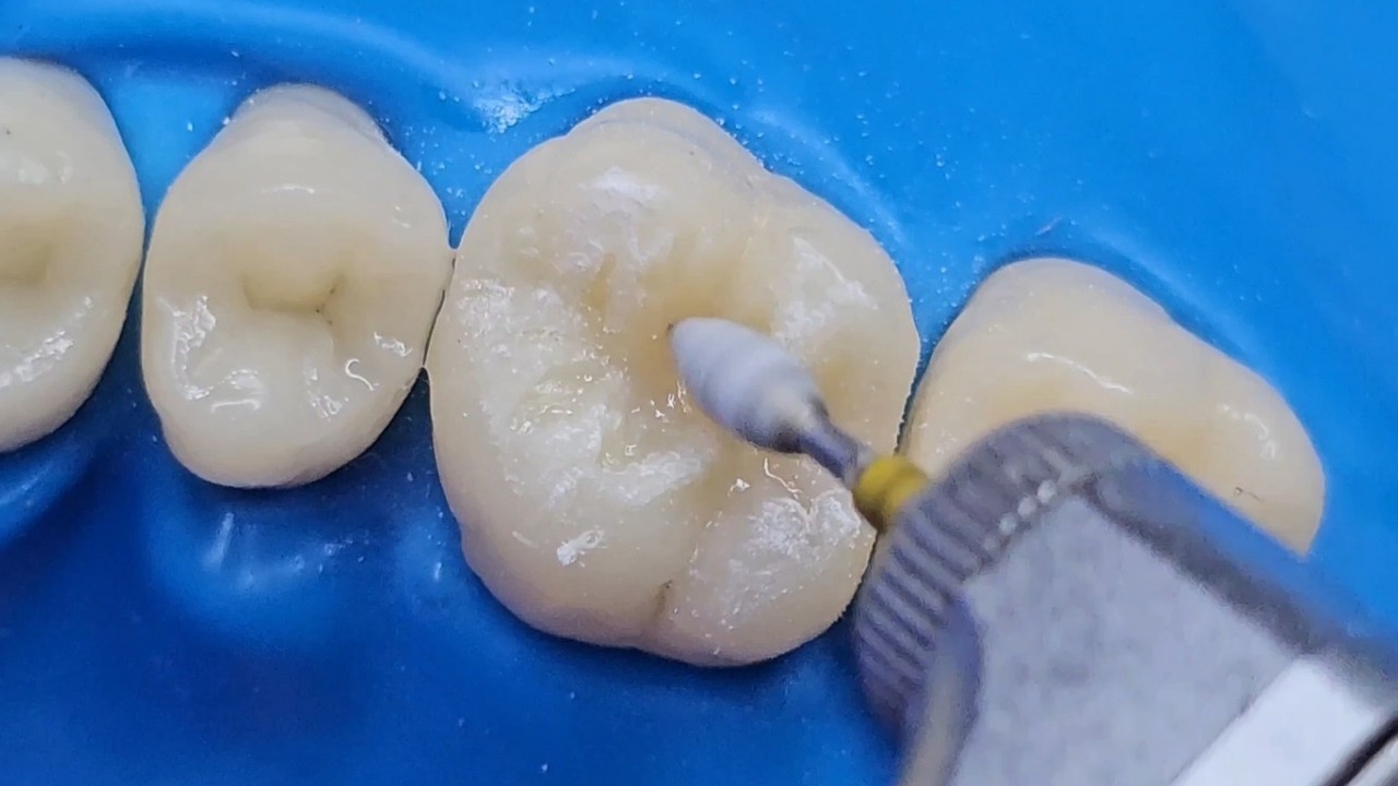 Satisfying Tooth Filling - Watch This Perfect Restoration ! - YouTube